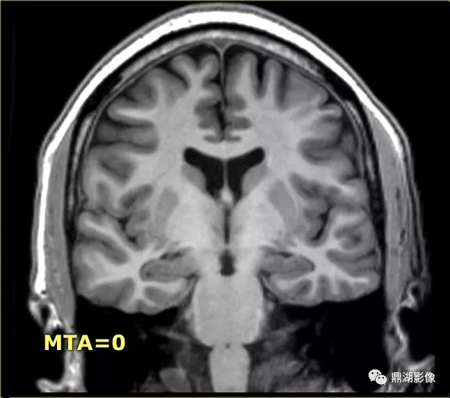 海马解剖及影像学评估_诊断