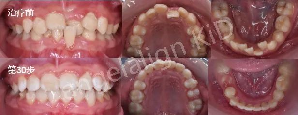隐形牙套与早期矫治间的“碰撞”｜走近时代天使儿童版_问题