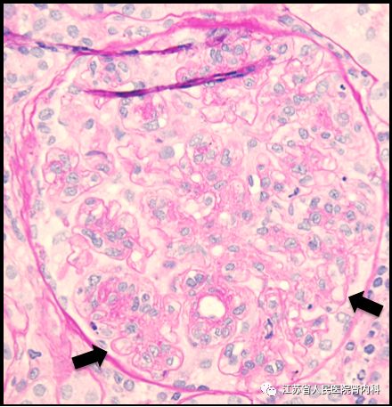 肾脏病理基础（九）增生性肾炎伴单克隆IgG沉积（PGNMID）_患者