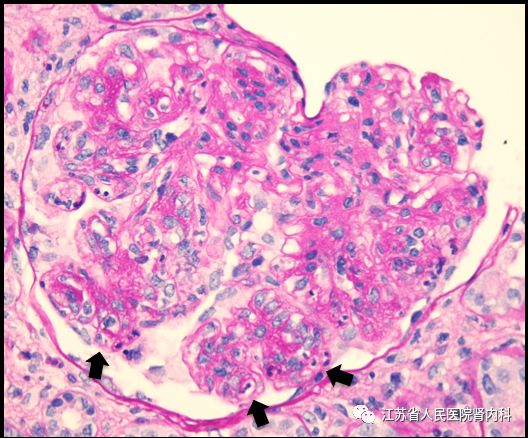 肾脏病理基础（九）增生性肾炎伴单克隆IgG沉积（PGNMID）_患者