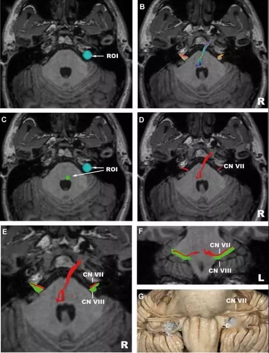 必须收藏 | 12对颅神经最全解剖图谱（系统解剖、CT、MR断层解剖、高分辨率DTI成像）_区选