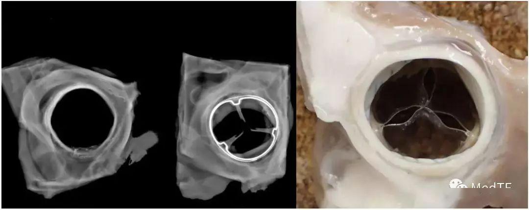 纯聚合物材质心脏瓣膜 ----Tria heart valves_Valve