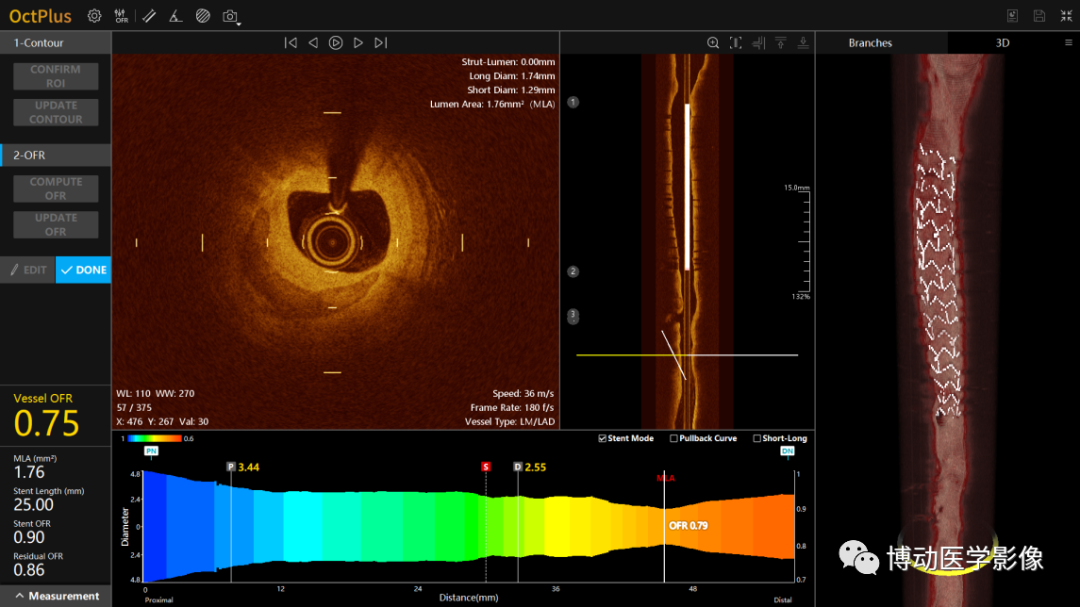 重磅！OFR获CE认证！成为全球首个获批的基于OCT的FFR评估技术-搜狐大视野-搜狐新闻