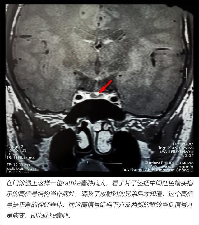 正常垂体的MRI表现_pars