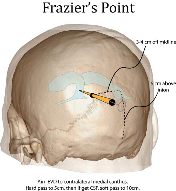 NEXUS手术技巧丨第六十三期：脑室内出血的治疗与管理_cm