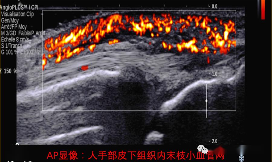 Angio Plus - 无创评估微灌注的好帮手-搜狐大视野-搜狐新闻