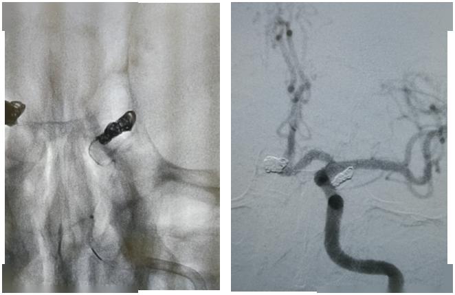术说丨“随遇而安”——Target弹簧圈的临床应用经验_mm