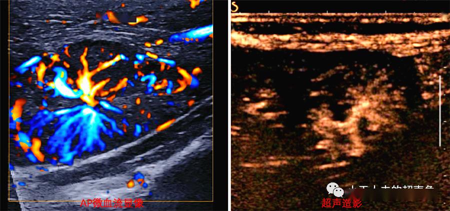 Angio Plus - 无创评估微灌注的好帮手-搜狐大视野-搜狐新闻