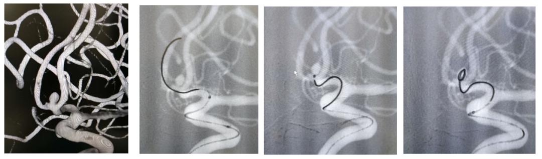 术说丨“随遇而安”——Target弹簧圈的临床应用经验_mm
