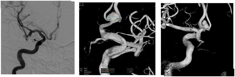 术说丨“随遇而安”——Target弹簧圈的临床应用经验_mm