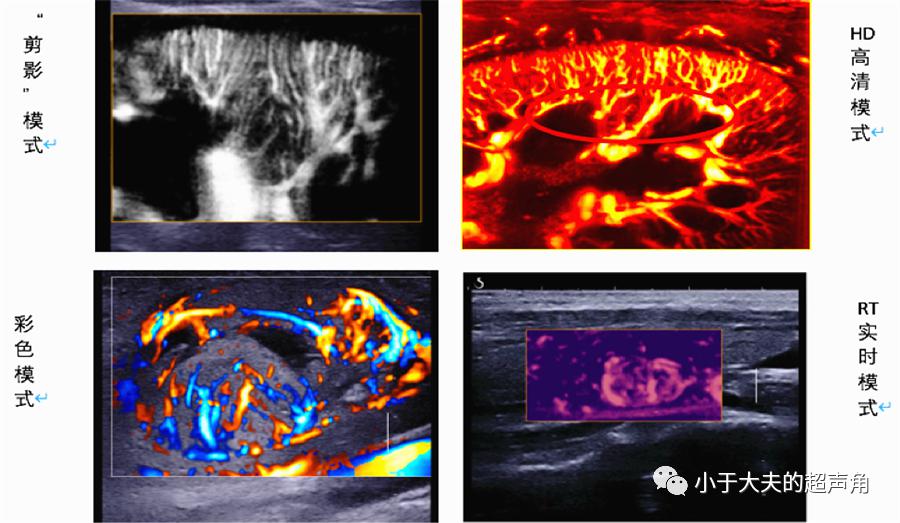 Angio Plus - 无创评估微灌注的好帮手-搜狐大视野-搜狐新闻