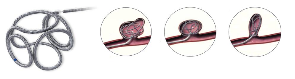 术说丨“随遇而安”——Target弹簧圈的临床应用经验_mm