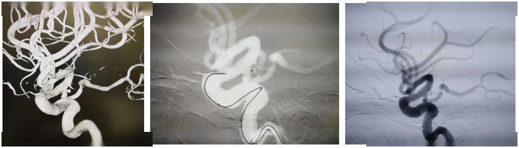 术说丨“随遇而安”——Target弹簧圈的临床应用经验_mm