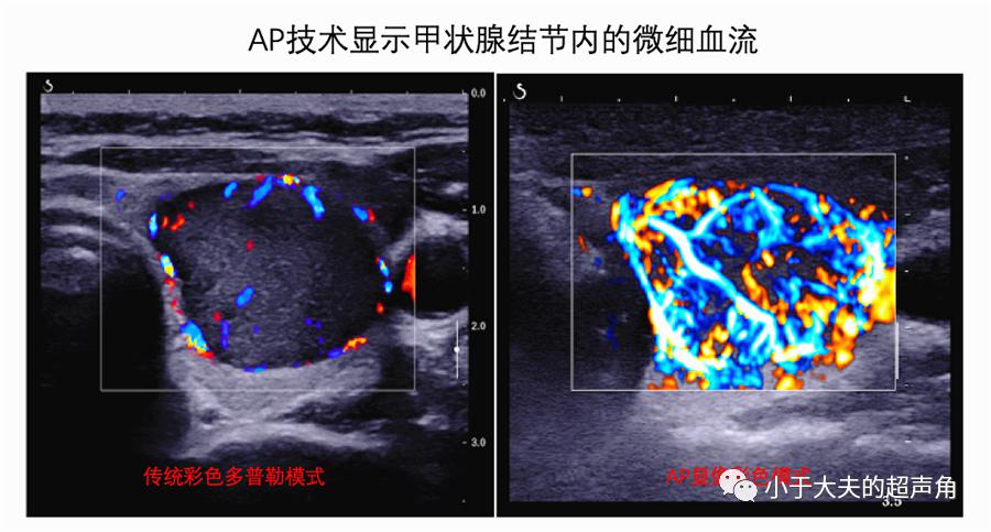 Angio Plus - 无创评估微灌注的好帮手-搜狐大视野-搜狐新闻