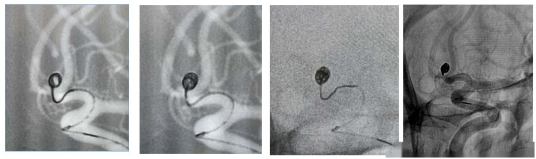 术说丨“随遇而安”——Target弹簧圈的临床应用经验_mm