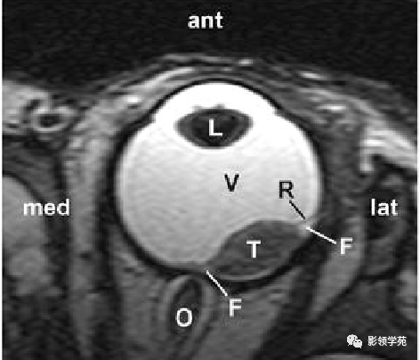 视网膜母细胞瘤（RB）影像学表现_钙化