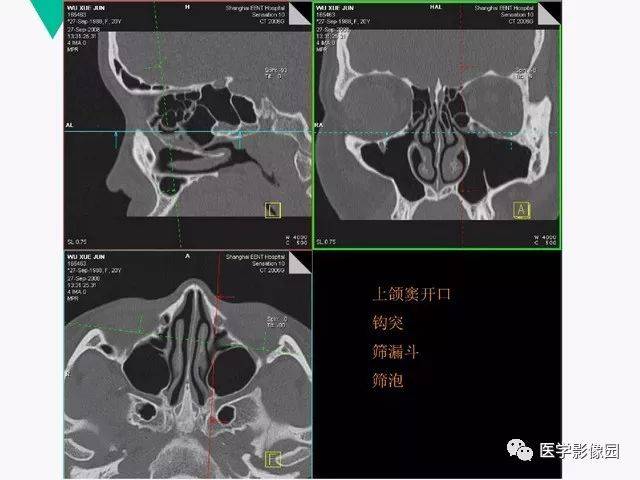 副鼻窦x线影像,副鼻窦t,副鼻窦(第2页)_大山谷图库