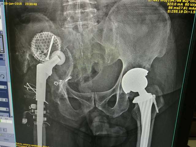 3D打印定制 Triflange Cup治疗髋臼超大缺损_搜狐网
