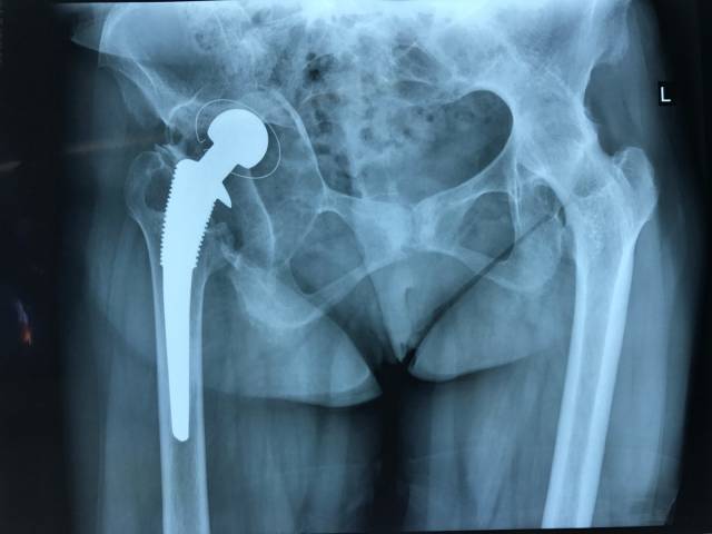 3D打印定制 Triflange Cup治疗髋臼超大缺损_搜狐网